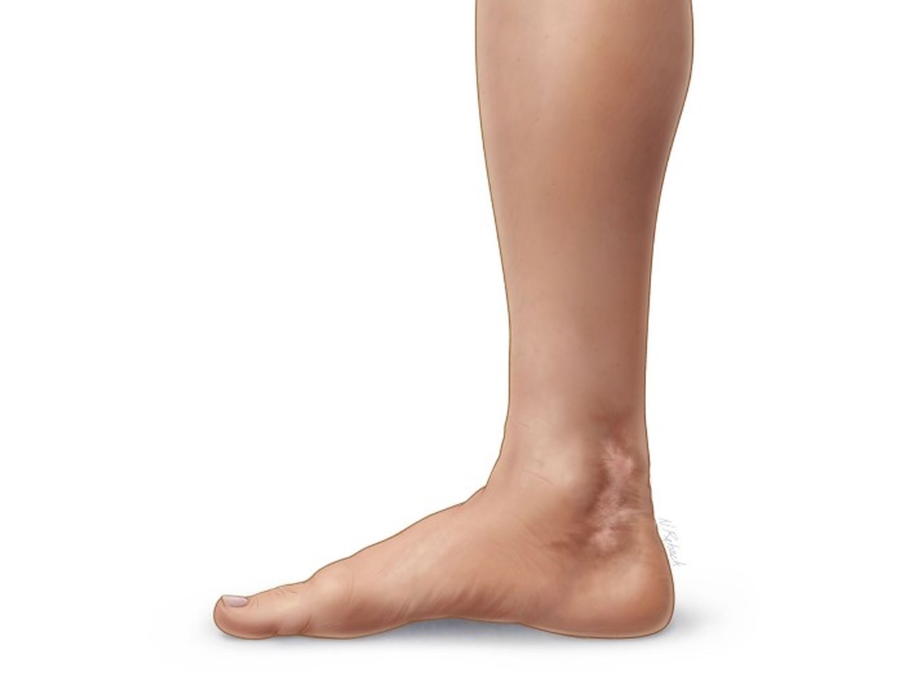 Doenças venosas crônicas (DVC) | Sigvaris.com