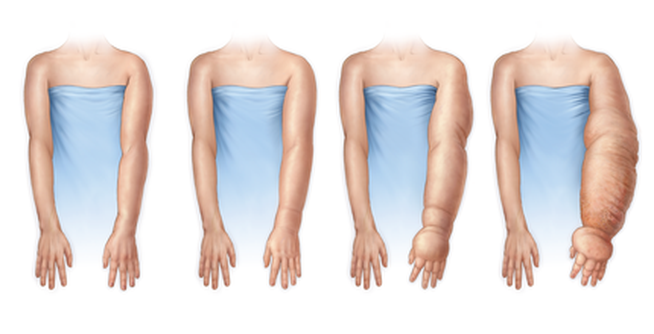 Lymphœdème et compression | Sigvaris.com