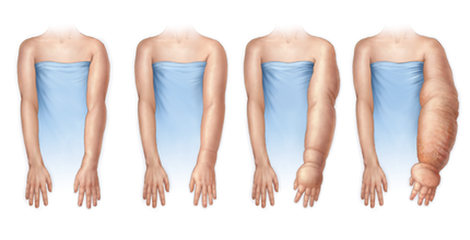Lymphedema Arm Compression Sleeves For Lymphedema