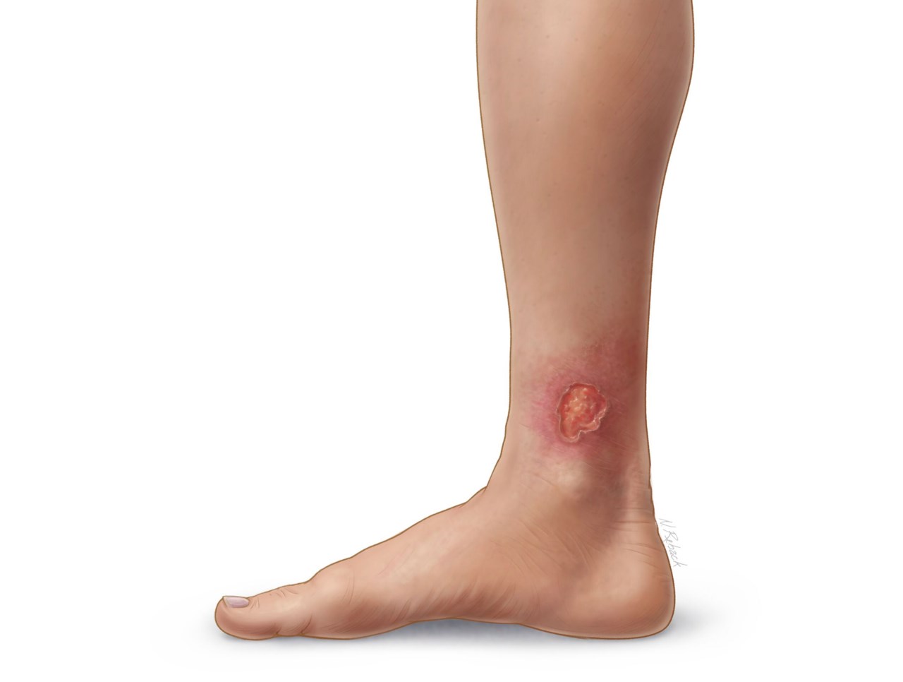 Chronic venous disorders (CVD) | Sigvaris.com