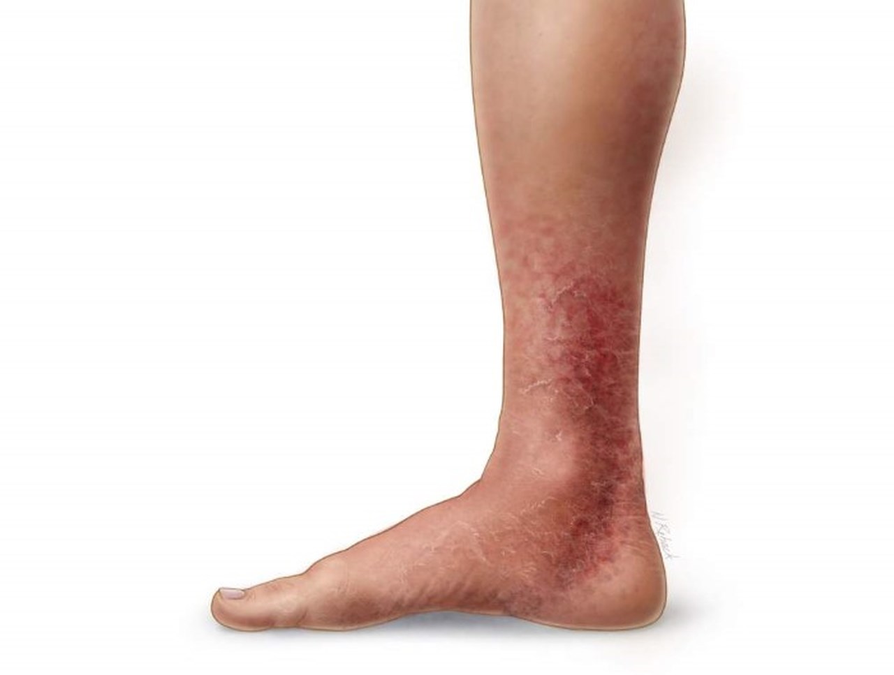 Doenças venosas crônicas (DVC) | Sigvaris.com