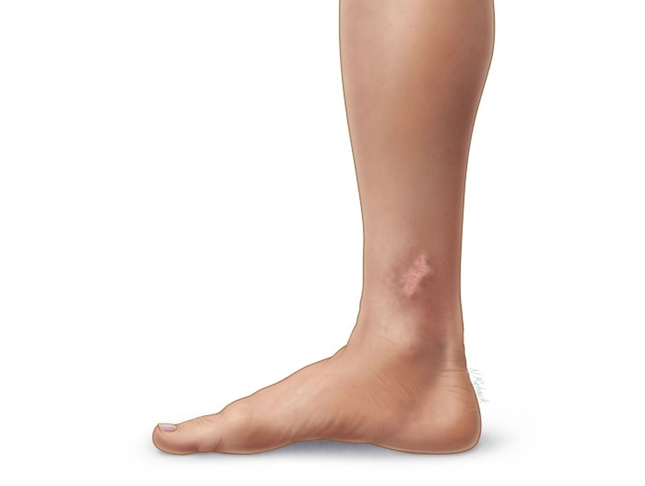 Doenças venosas crônicas (DVC) | Sigvaris.com